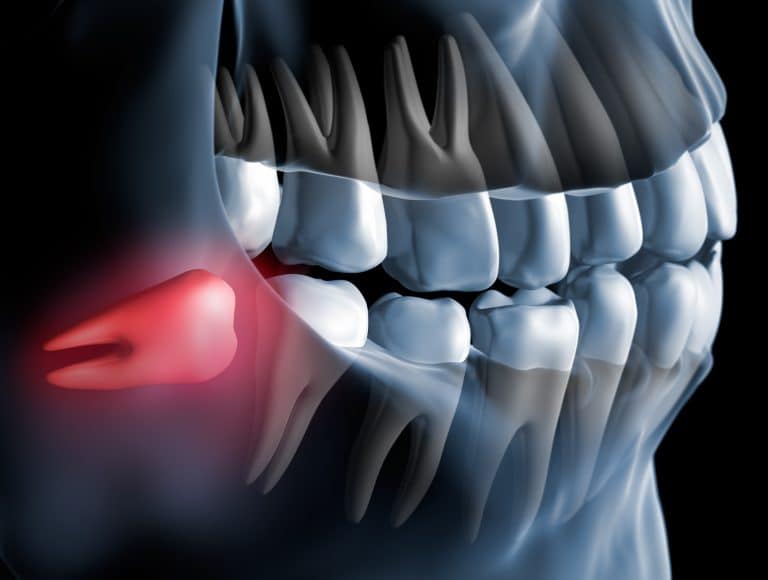 el-paso-dentists-explain-how-we-extract-a-tooth-el-paso-tx