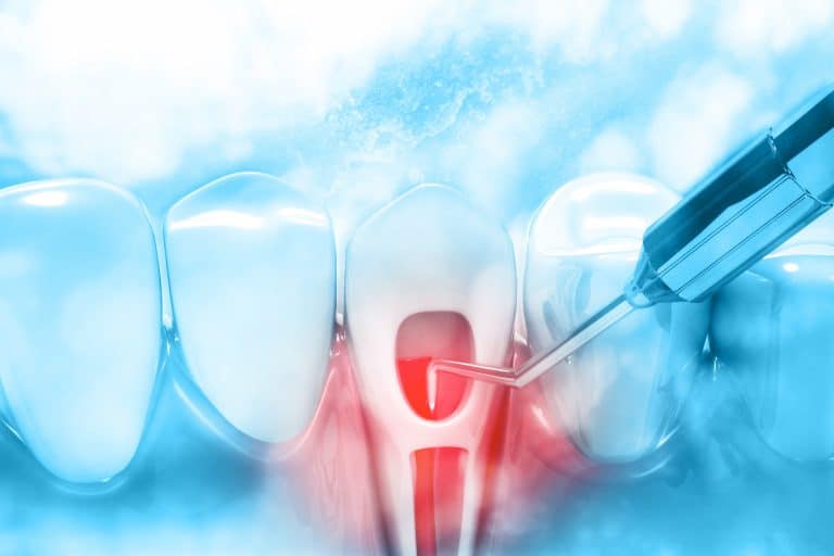 El Paso Dentists Explain What To Do When A Cavity Becomes An Infection ...