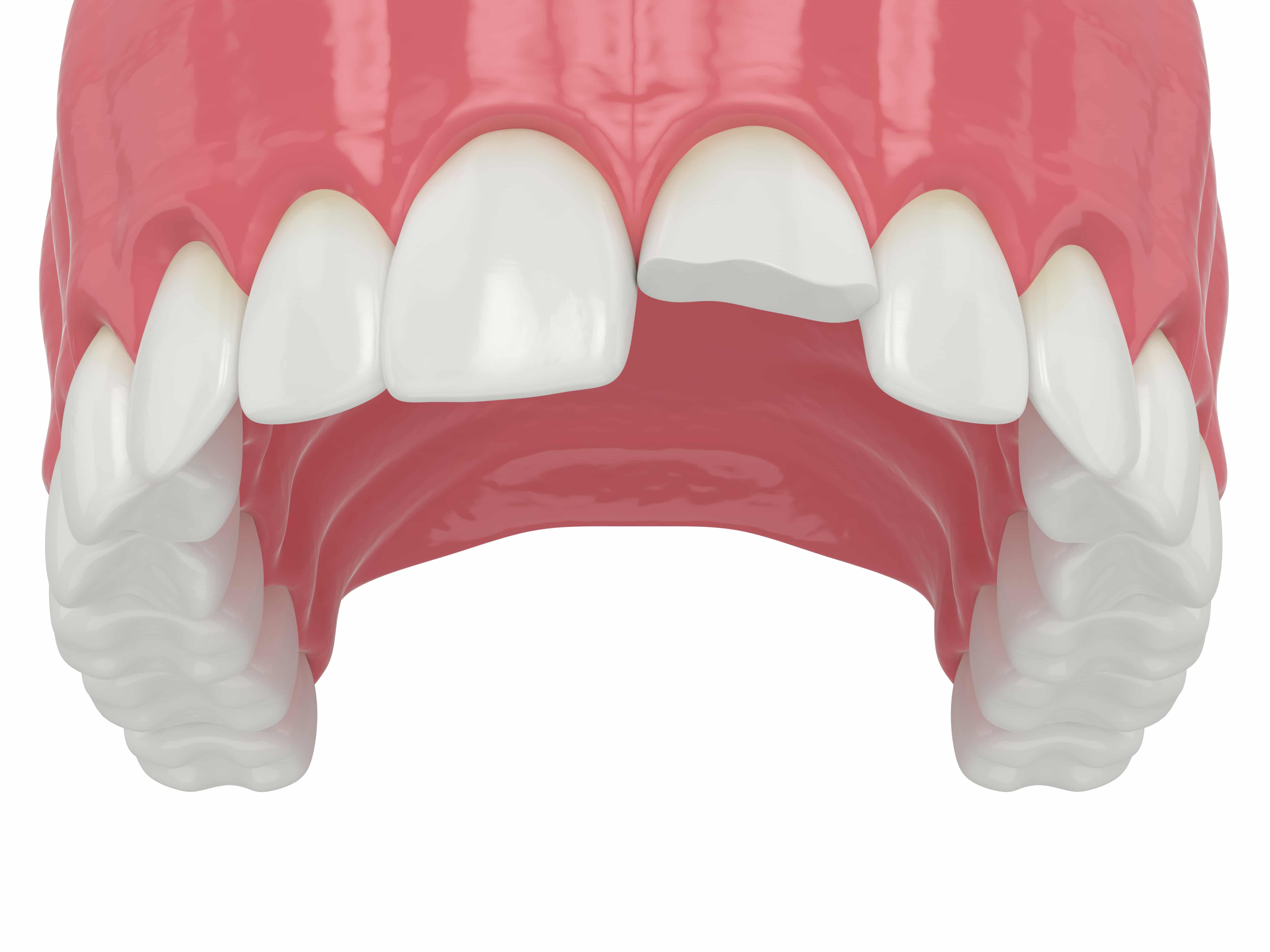 El Paso Dentists Talk About Chipped Teeth And Other Dental Emergencies ...