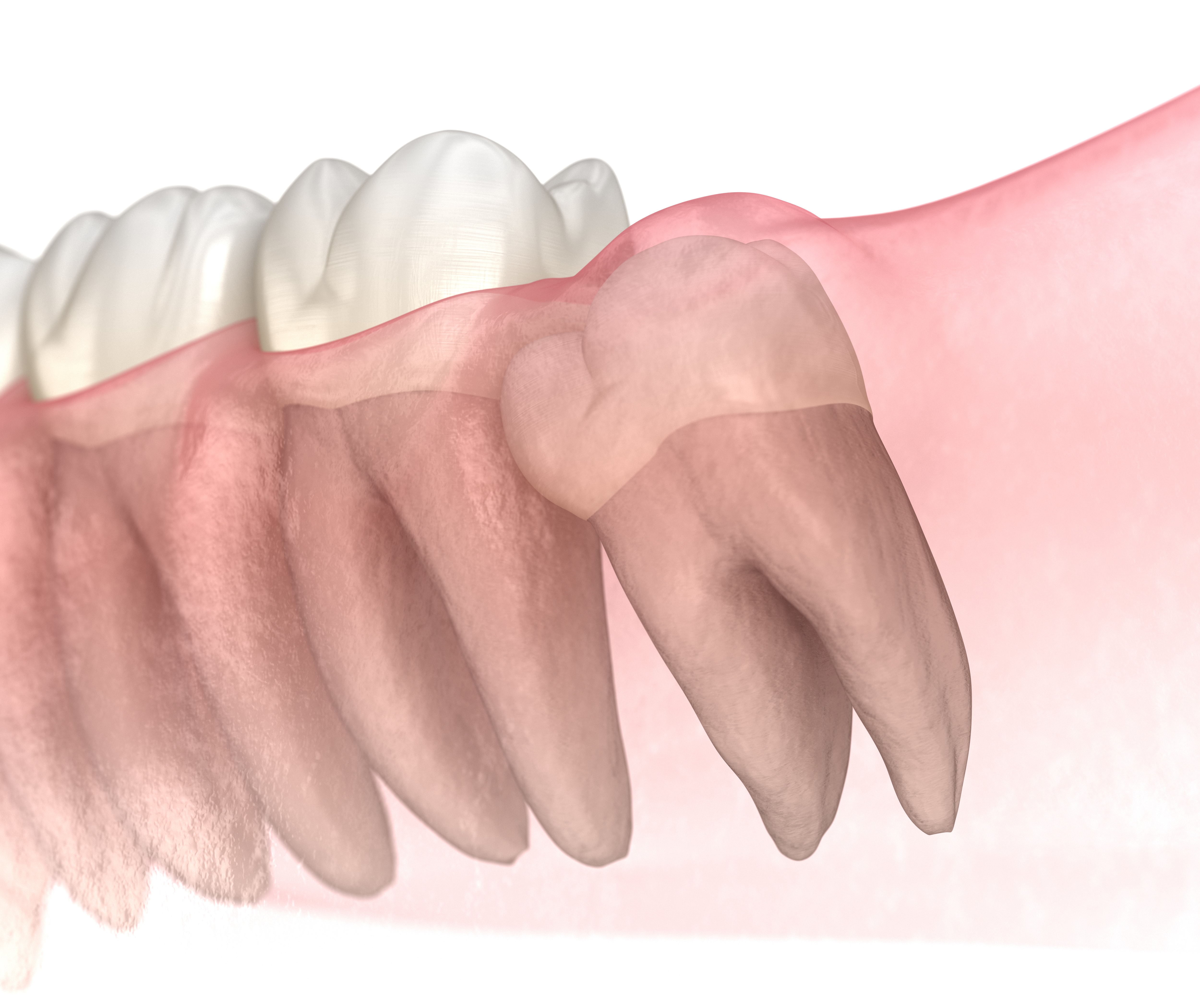 El Paso Dentists Explain How We Address Wisdom Teeth | El Paso, TX