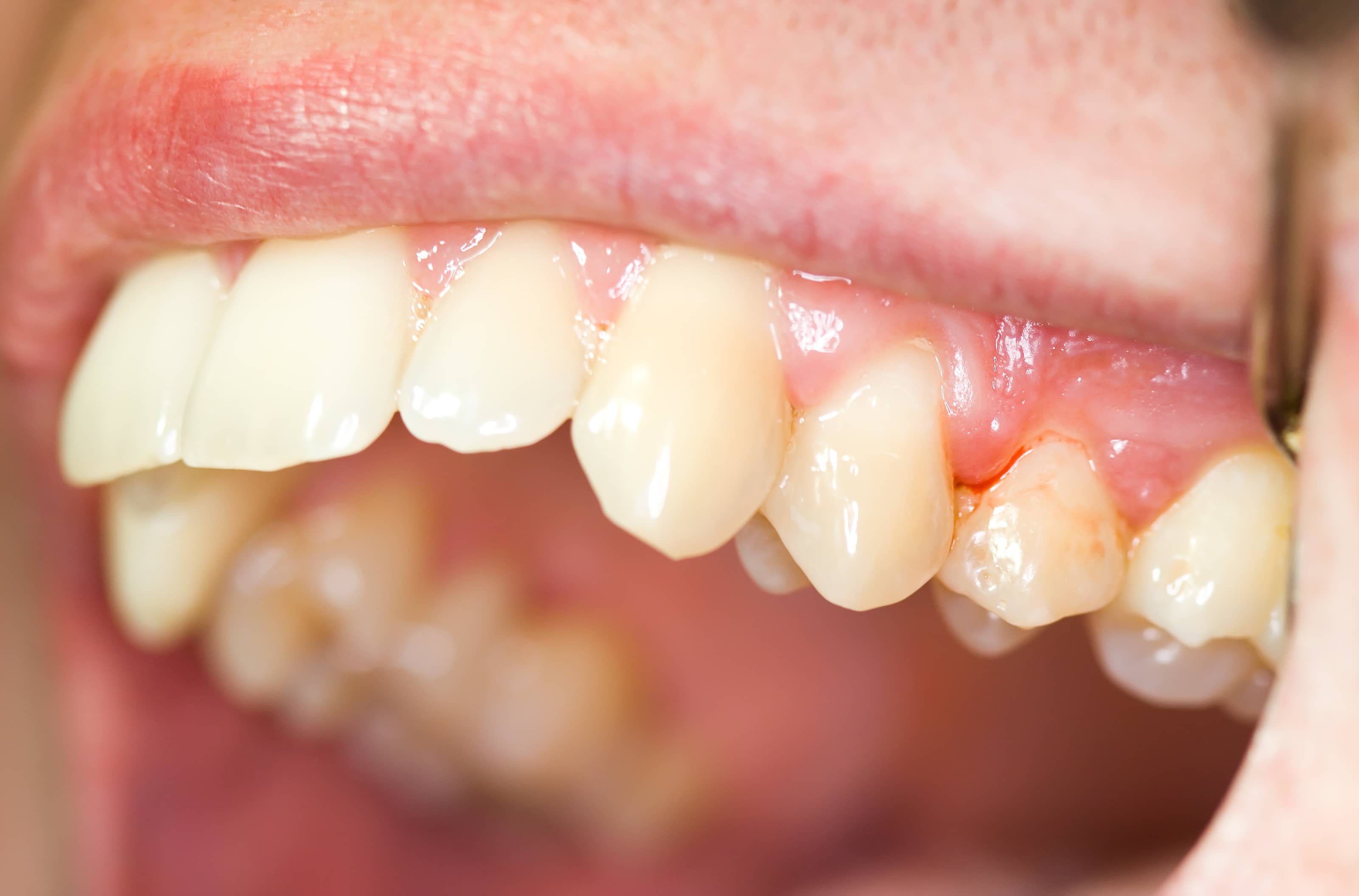 El Paso Dentists Can Stop Gingivitis From Threatening Your Periodontal ...