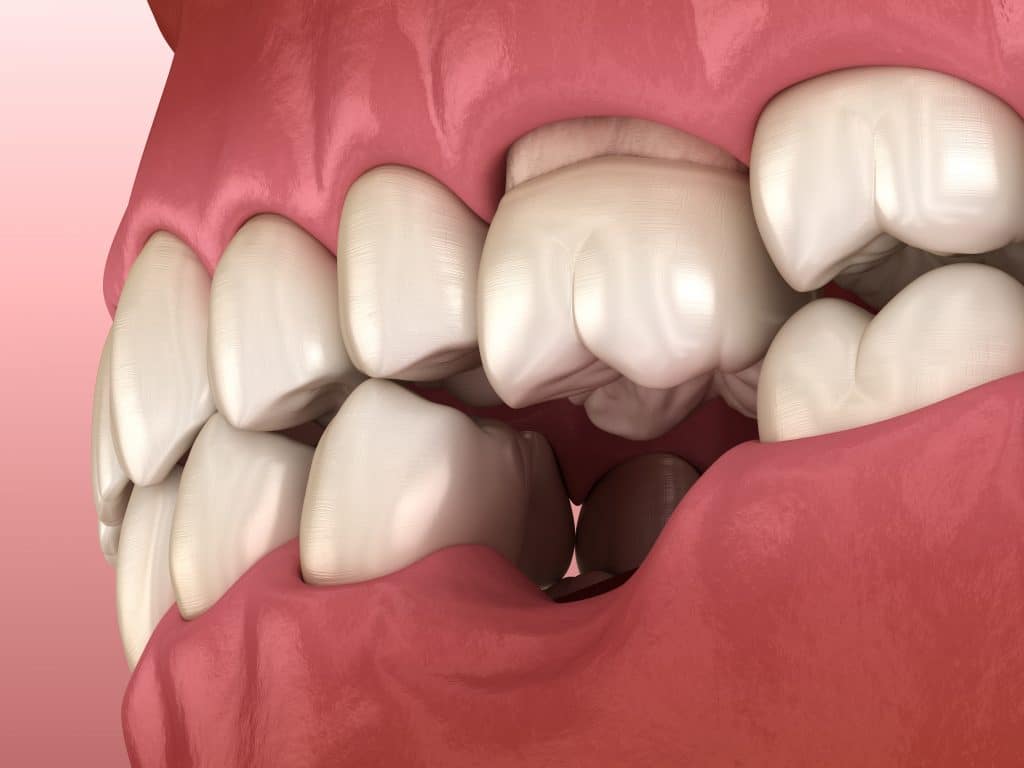 El Paso Dentists Explain How To Preserve Our Natural Teeth | El Paso, TX