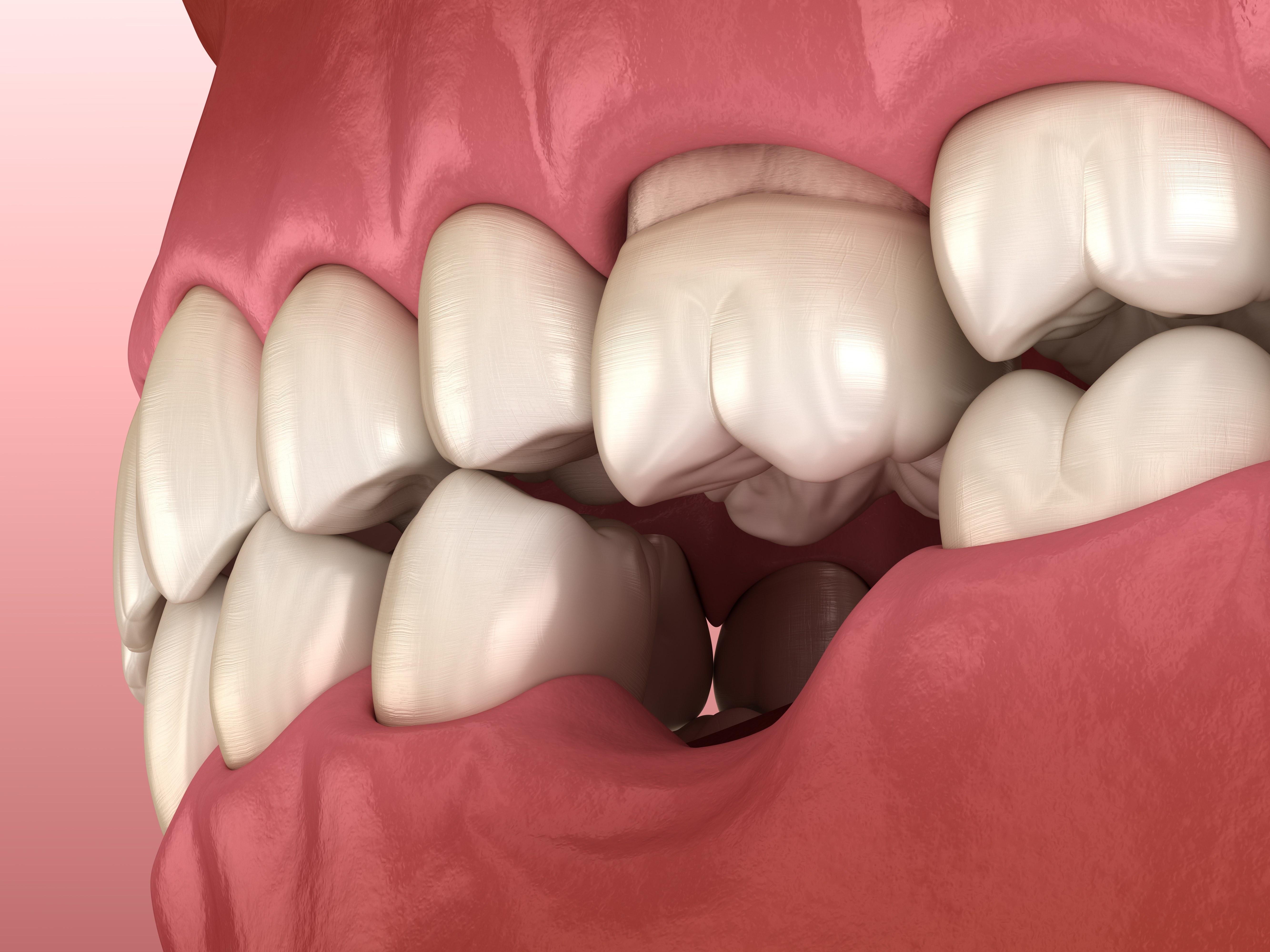 El Paso Dentists Explain How To Preserve Our Natural Teeth | El Paso, TX