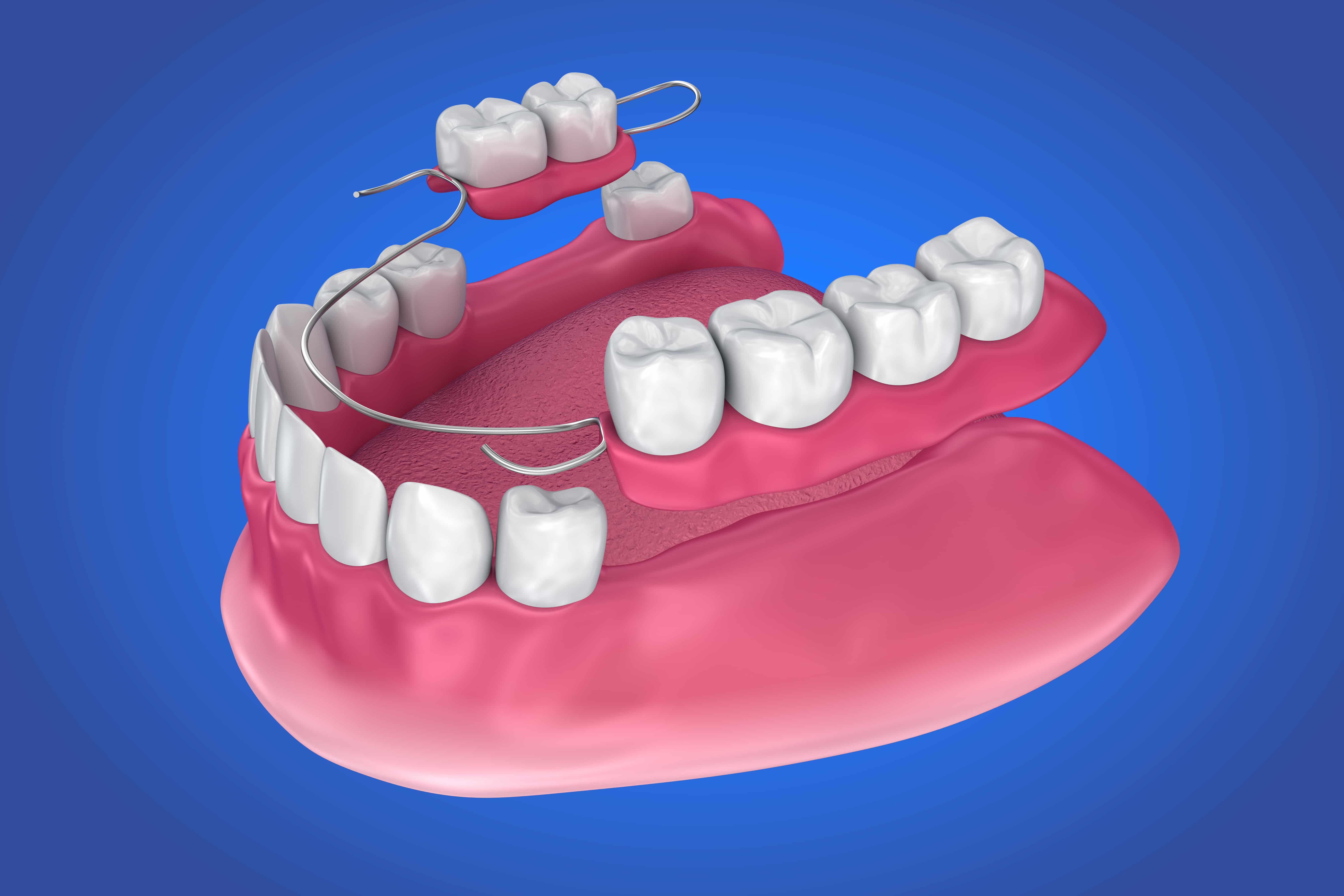 El Paso Dentists Explain When Your Smile Needs A Partial Denture | El Paso, TX