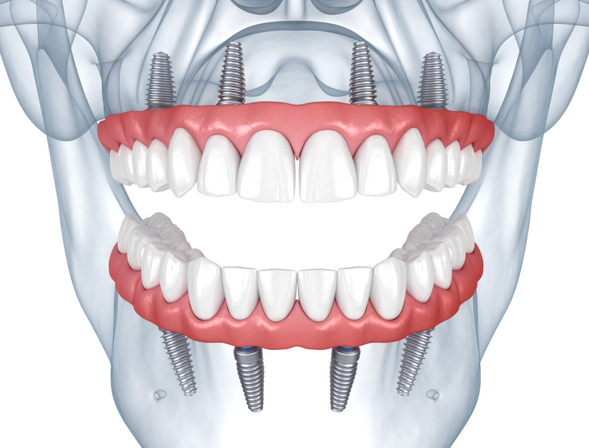A Full Smile With All-On-Four Implant Dentures | El Paso, TX