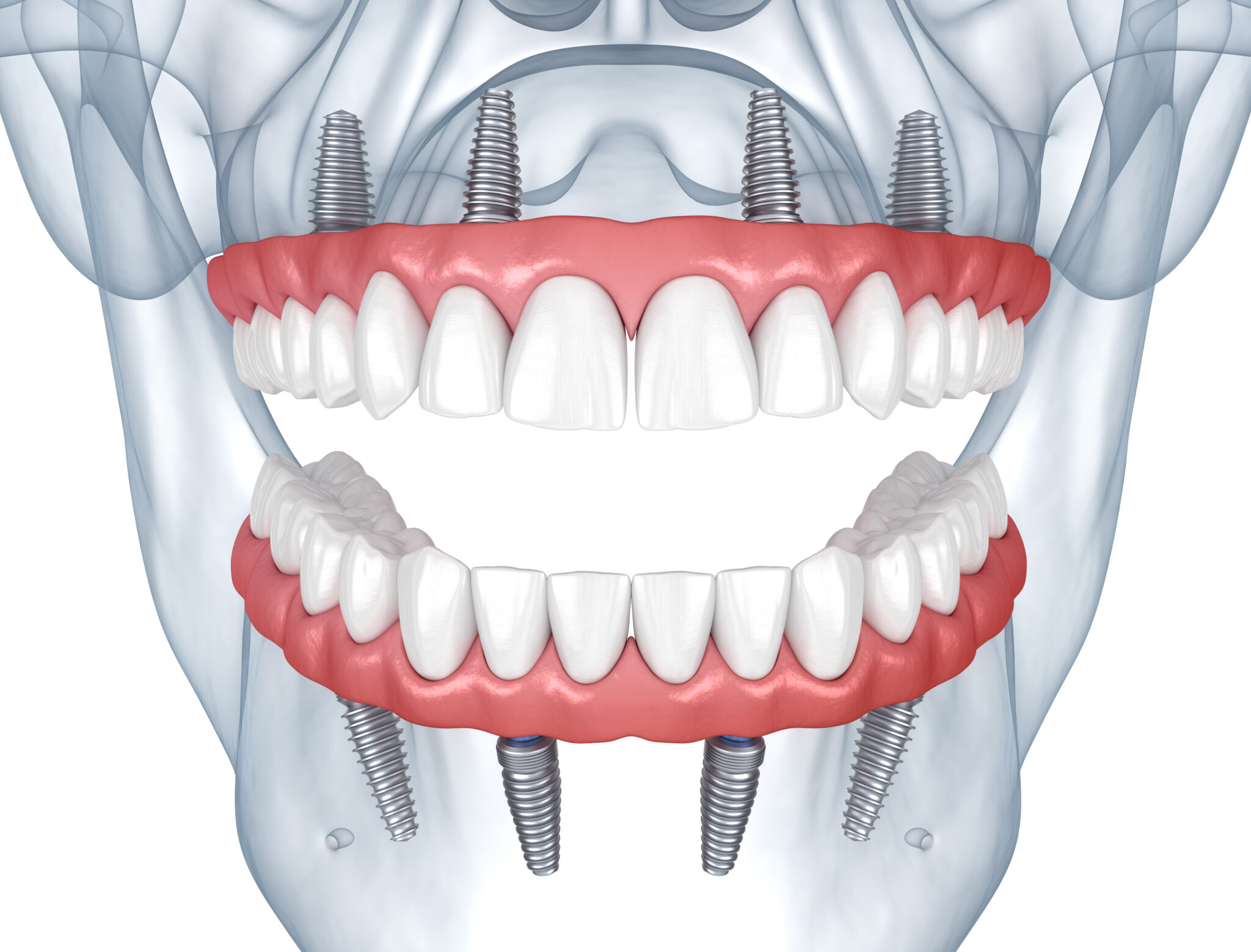 A Full Smile With All-On-Four Implant Dentures | El Paso, TX