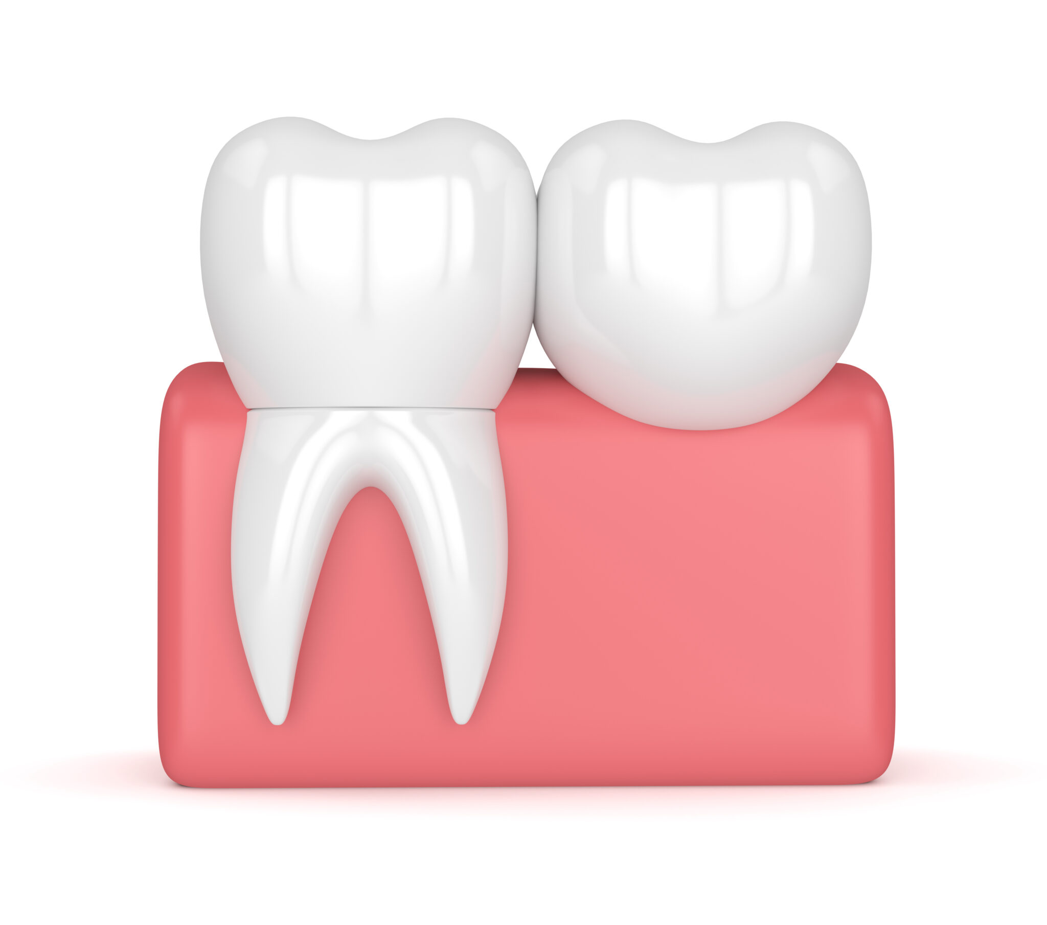 Does Your Smile Need A Dental Bridge? | El Paso, TX