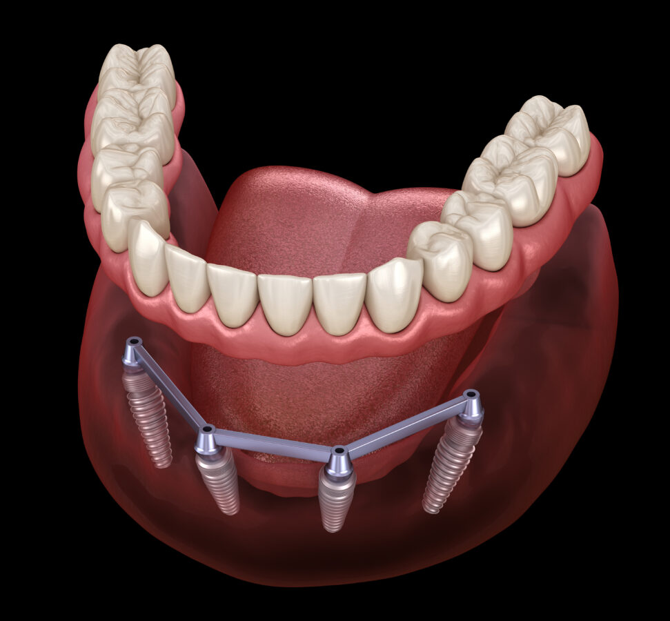 Implant Dentures In One Visit With All-On-Four | El Paso, TX