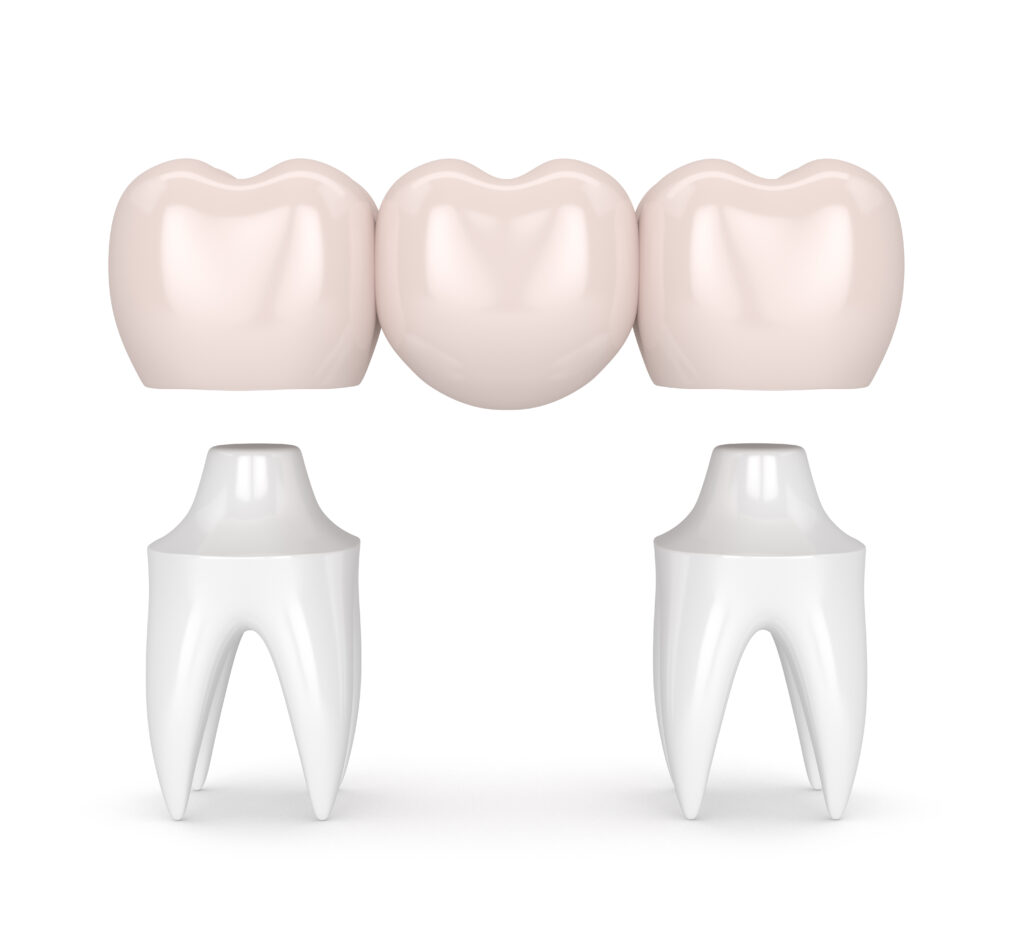 Replacing Your Lost Teeth With Custom Bridges | El Paso, TX