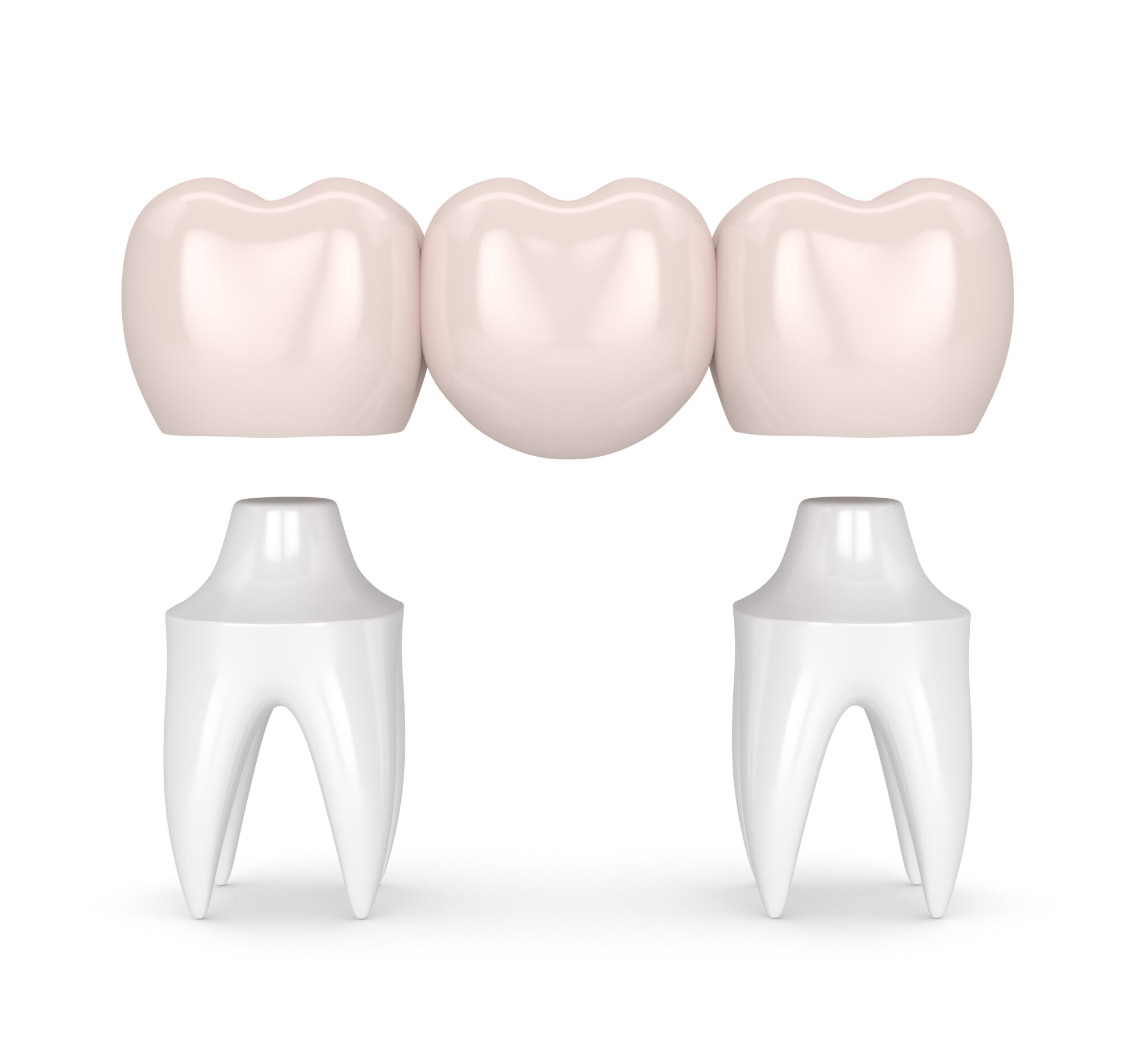 Replacing Your Lost Teeth With Custom Bridges | El Paso, TX