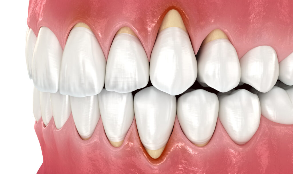 Treating Gingivitis With A Deep Cleaning | El Paso, TX