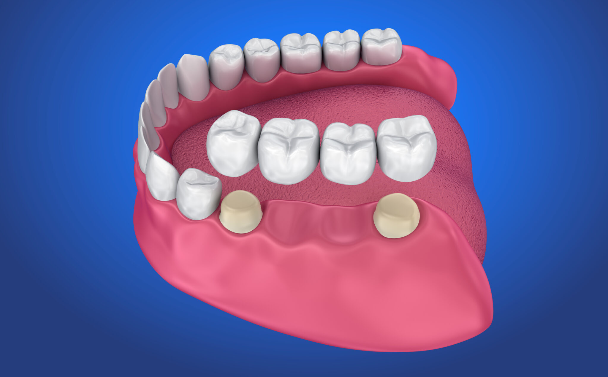 A Dental Bridge Provides Complete Smiles Again | El Paso, TX