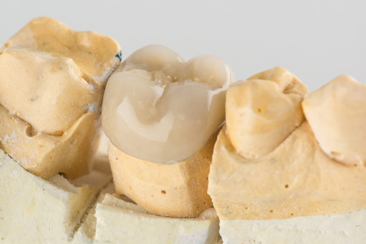 How Dental Crowns Could Save Your Tooth | El Paso, TX